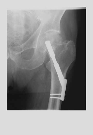 Fixed Femur, 20" x 30" - Contemporary - Prints And Posters - by ...