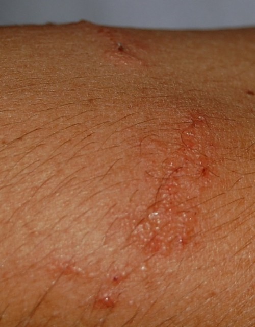 "Mystery poison ivy," contact dermatitis rash from house plants
