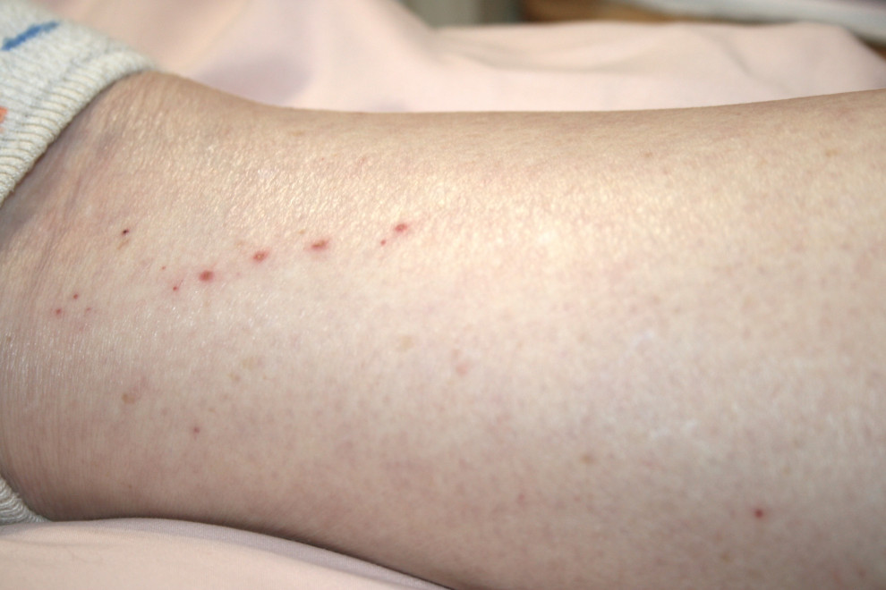 Are these Shingles on my calf?